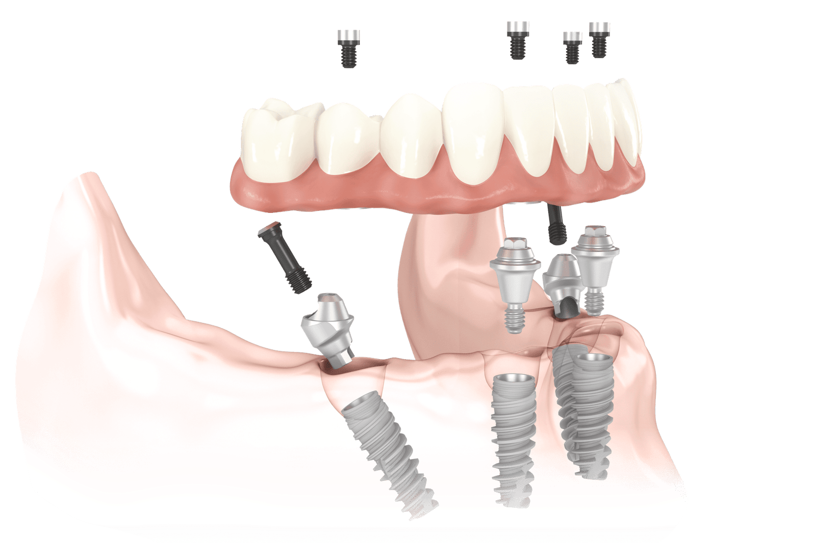 Prótese protocolo em Itapevi - prótese sobre implante - protocolo dentário