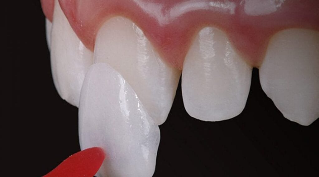Facetas de Resina ou Porcelana? Qual a Melhor Escolher